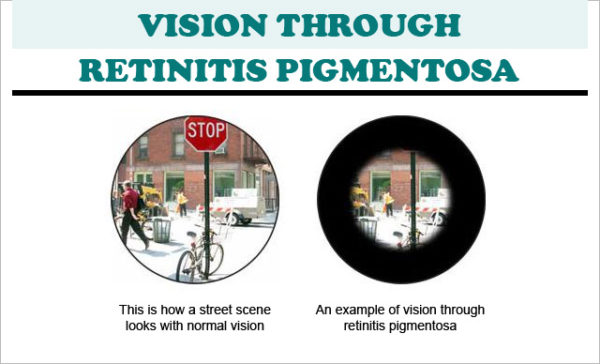 Retinitus Pigmentosa – Cates Family Eye Care